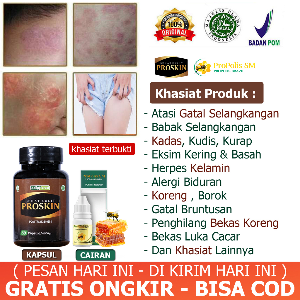 Jual Obat Gatal Selangkangan Babak Kadas Kurap Kudis Herpes Kelamin Alergi Biduran Di Kulit ...