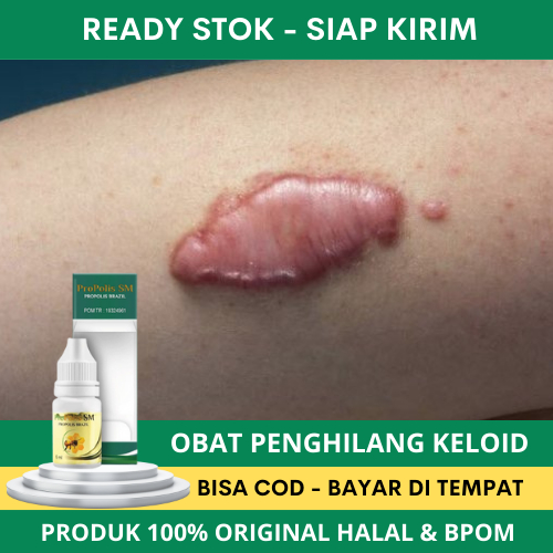 Jual Obat Keloid, Obat Keloid Daging Tumbuh, Obat Penghilang Keloid ...