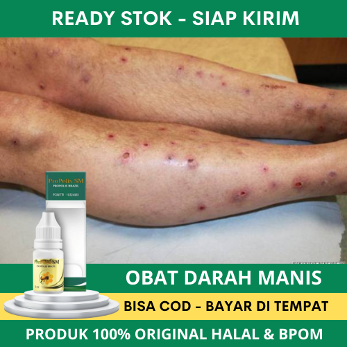 Jual Obat Darah Manis, Bentol, Prurigo, Penyakit Kulit, Kulit Gatal ...