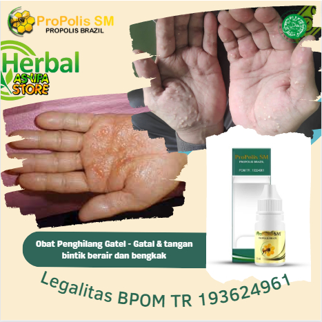 Jual Obat Penghilang Gatel - Gatal & tangan bintik berair dan bengkak ...