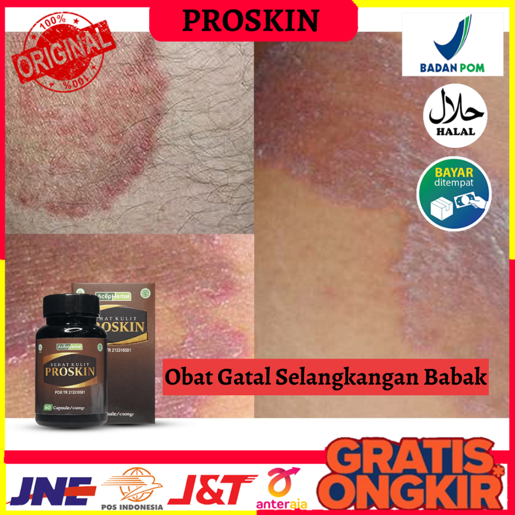 Jual Obat Gatal Selangkangan Babak Kulit Berjamur Bersisik Selangkangan ...