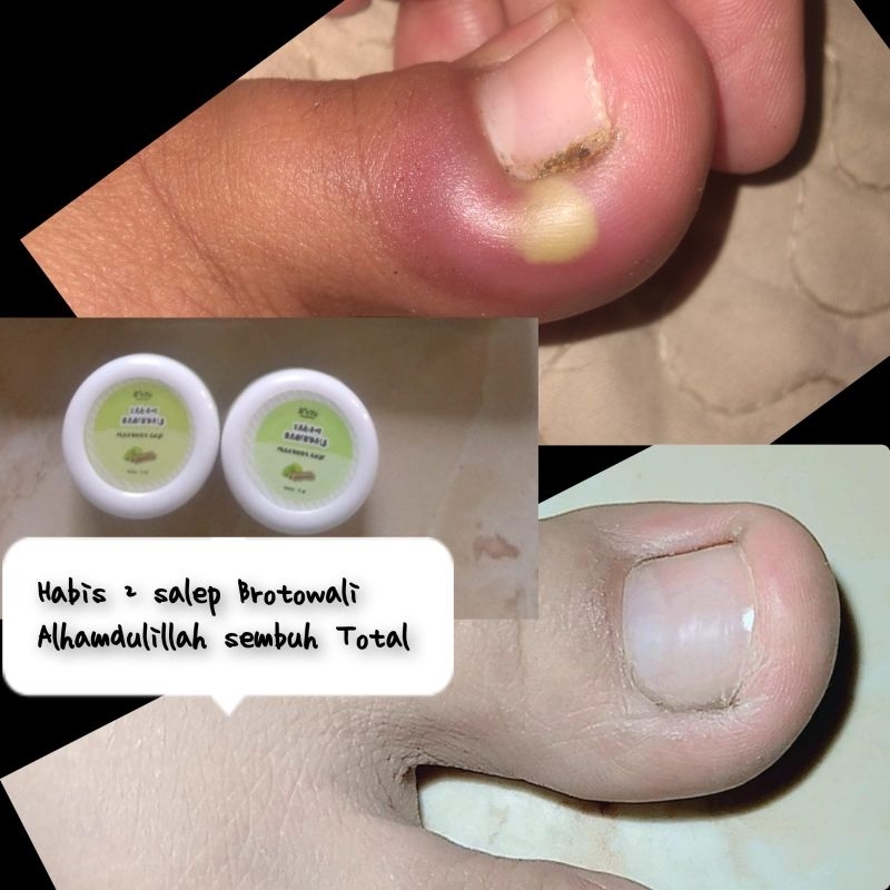 Jual cream brotowali bnyu salep gatal gatal | Shopee Indonesia