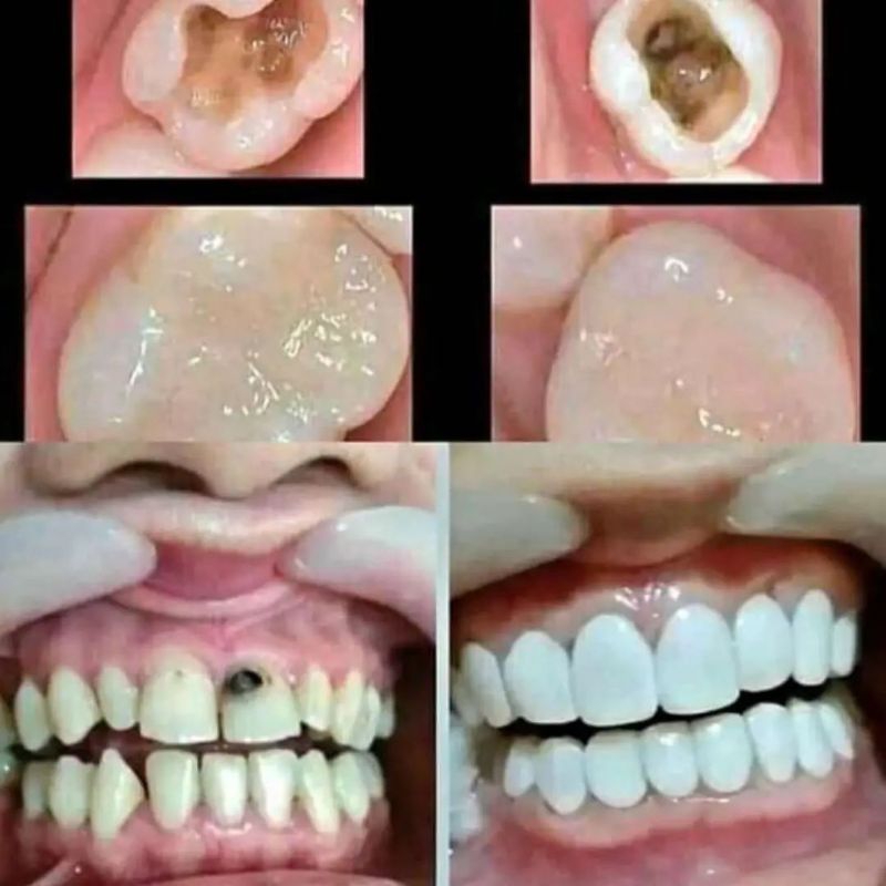 Jual PRODUK PENUMBUH GIGI BERLUBANG | Shopee Indonesia