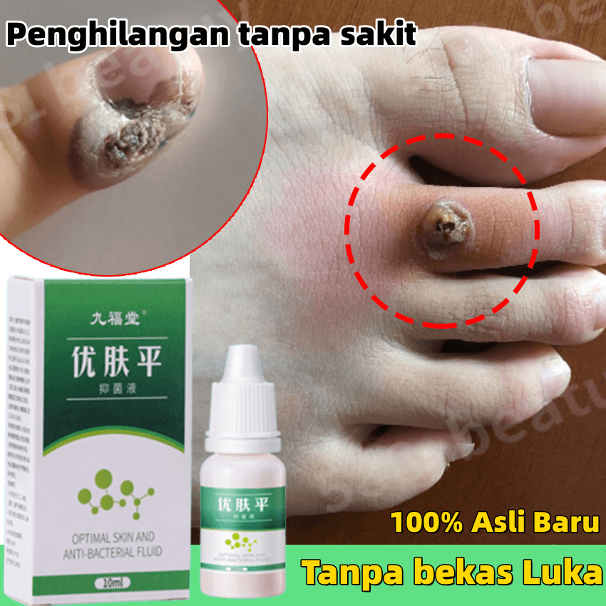 Jual Obat kutil Obat mata ikan Wart remover Skin tag remover 10ml ...
