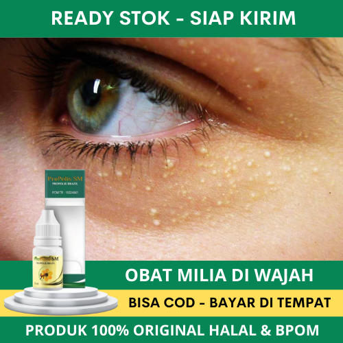 Jual Obat Milia, Obat Milia di Mata, Obat Milia Di Atas / Bawah Mata ...