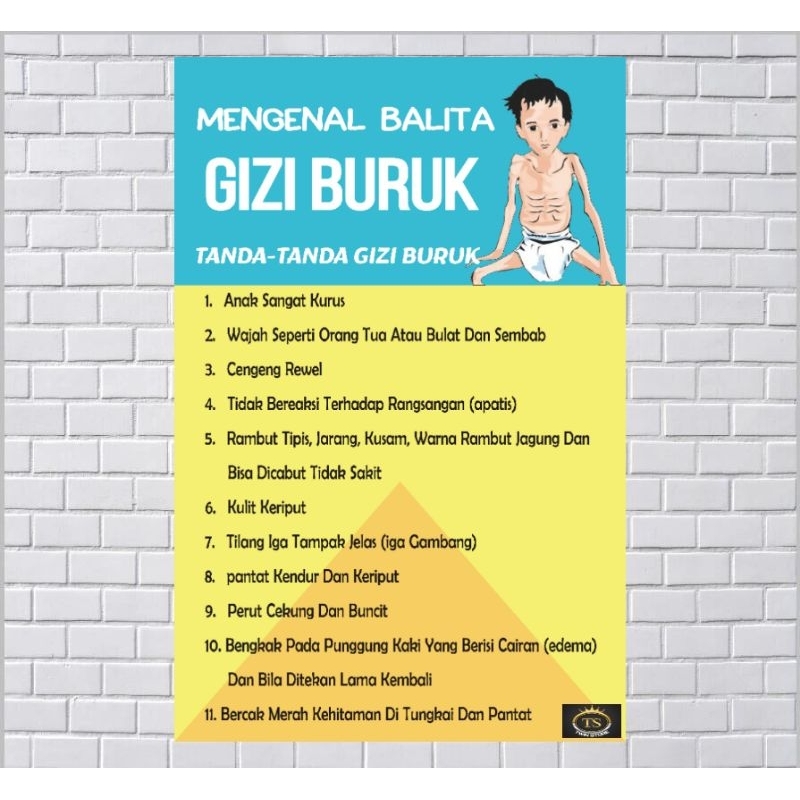 Jual Poster Kesehatan Tentang Gizi Buruk Pada Balita = Tanda-Tanda Gizi ... Jual Poster Kesehatan Tentang Gizi Buruk Pada Balita = Tanda-Tanda Gizi ...