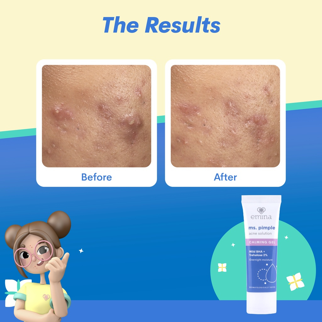 Jual Emina Ms. Pimple Acne Solution Calming Gel 20 mL - Pelembab Malam ...
