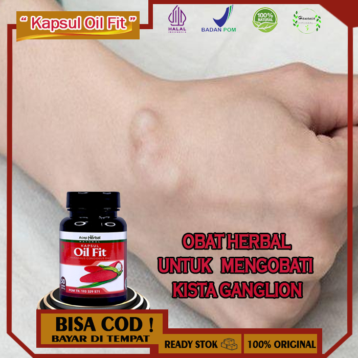 Jual Obat Kista Ganglion, Obat Pengempis Kista Ganglion Di Tangan, Oil ...
