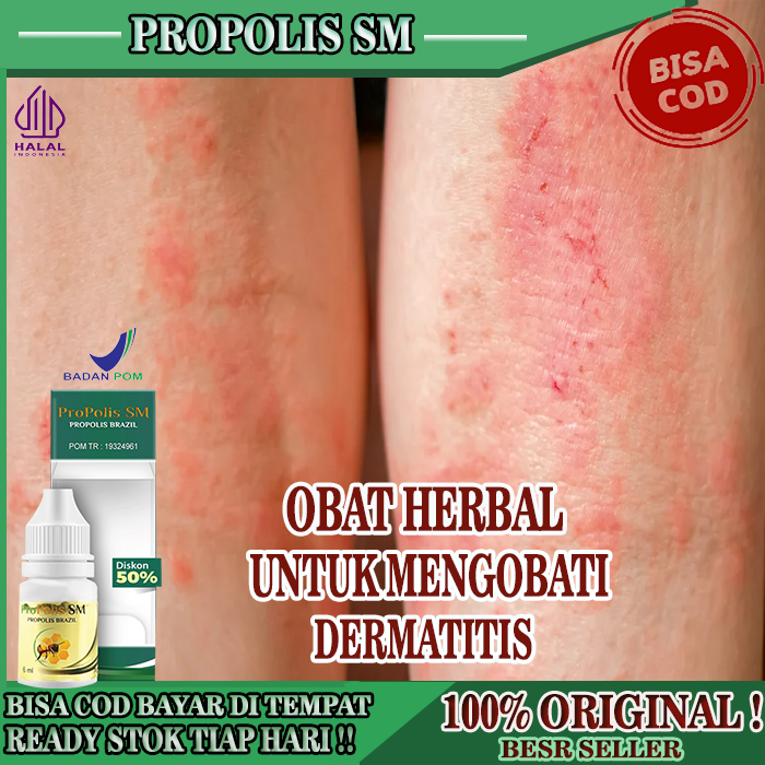 Jual Obat Penyakit Kulit Dermatitis , Obat Eksim Gatal Kulit Dermatitis ...
