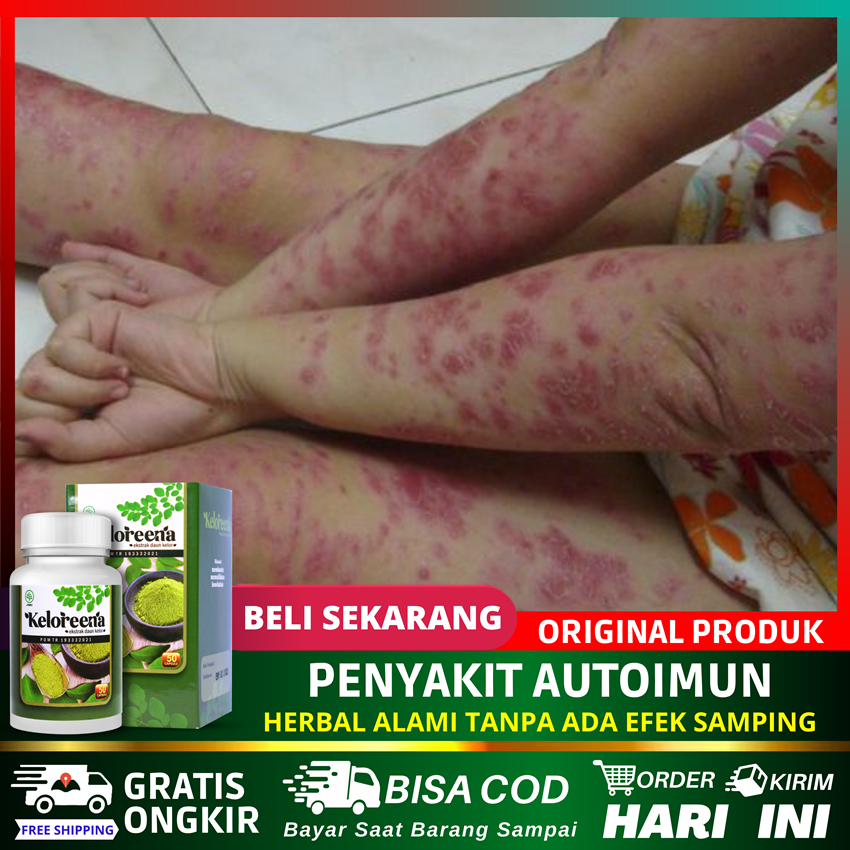 Jual Obat Autoimun Penyakit Kulit Lupus Psoriasis Ruam Kulit Demam ...