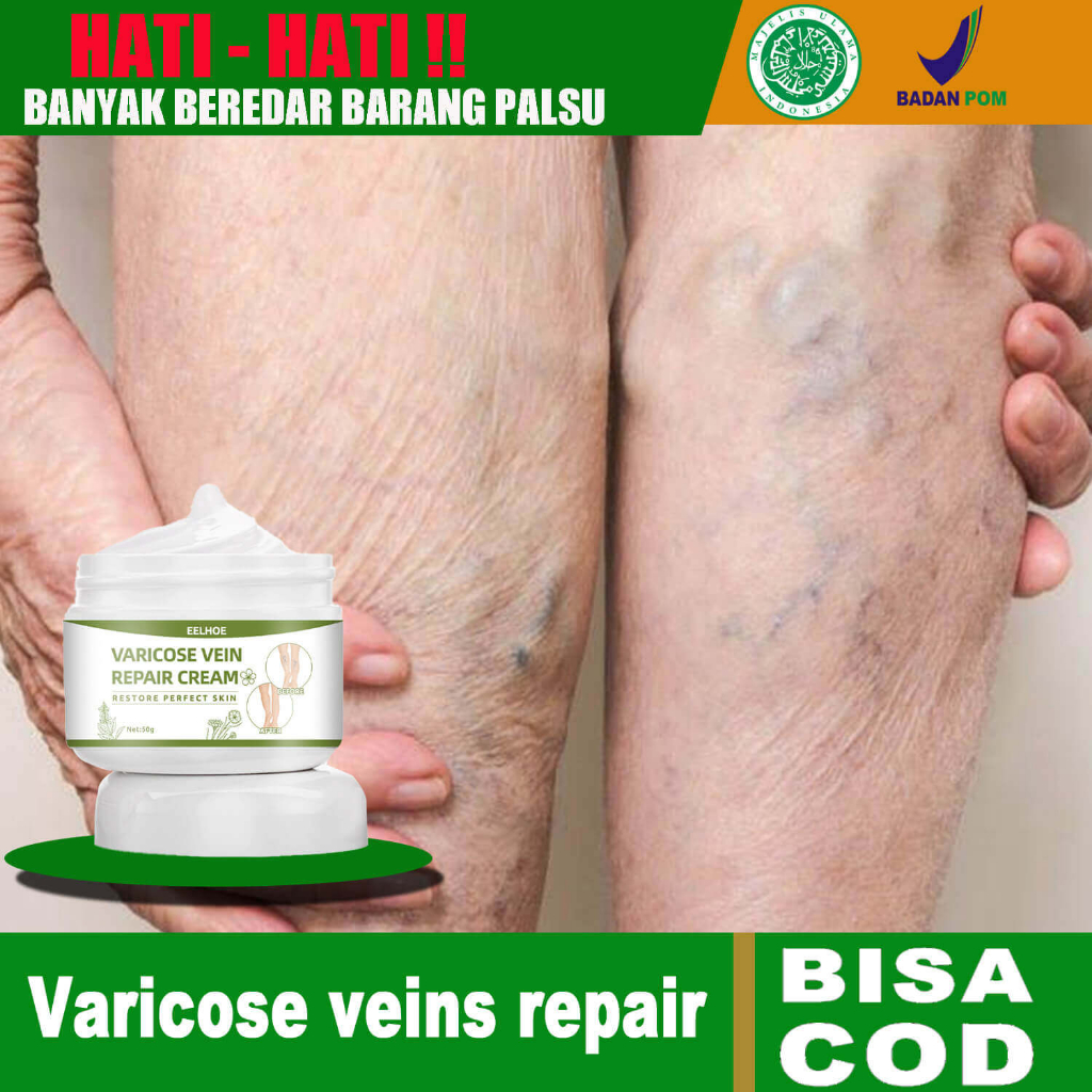 Jual Obat Varises Salep Penghilang Varises Cream 50g, Parises Tanpa ...