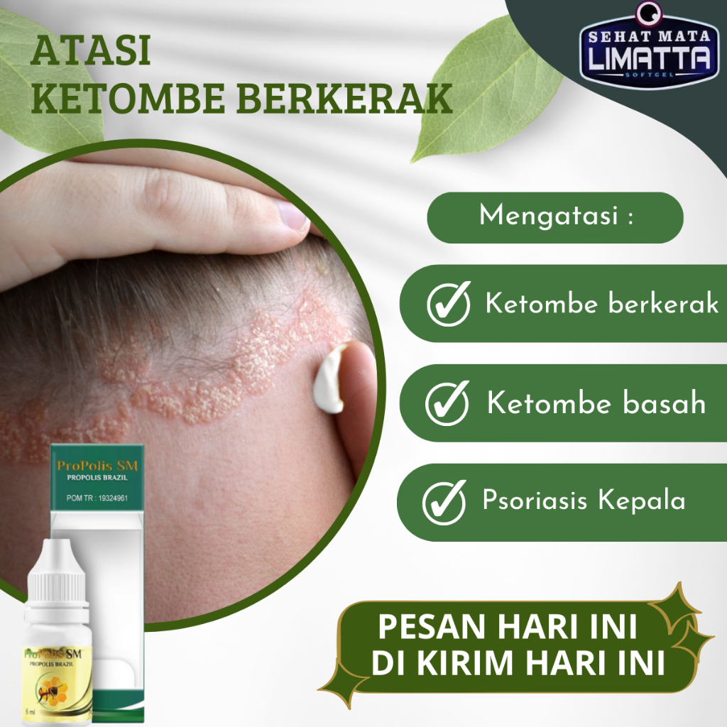 Jual Propolis SM - Penghilang Infeksi Jamur Kepala, Psoriasis Kulit Kepala, Ketombe Parah, Kulit ...