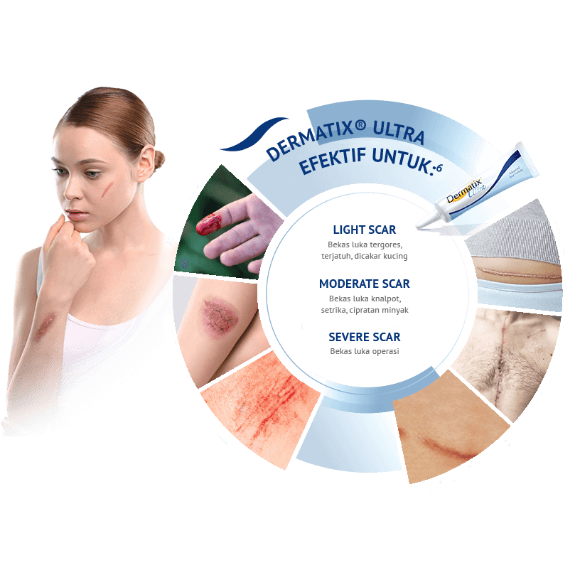 Jual Dermatix Ultra 15gr cream penghilang keloid/stretch mark/bekas ...