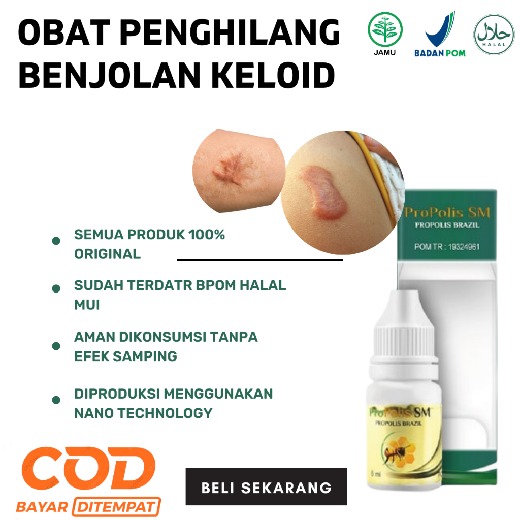 Jual Propolis SM - Obat Penghilang Benjolan Keloid Daging Tumbuh, Keloid Injeksi, Keloid Bekas ...