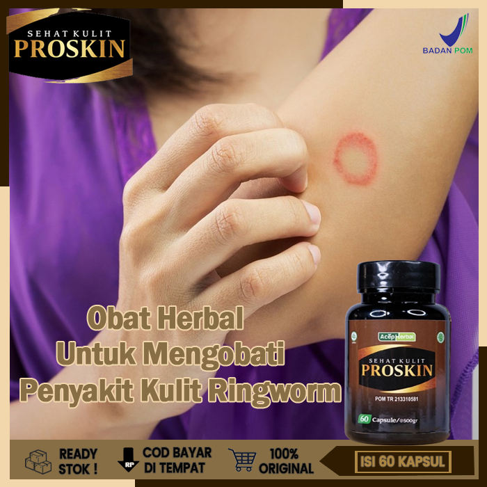 Jual Obat Kulit Ringworm, Penyakit Kulit Gatal Infeksi Jamur Ringworm ...