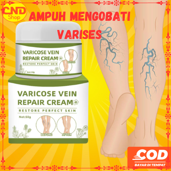 Jual Obat Salep Varises Cream Paling Ampuh 50mg | Shopee Indonesia