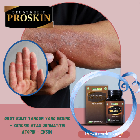Jual PROSKIN - Obat kulit tangan yang kering - xerosis atau dermatitis ...