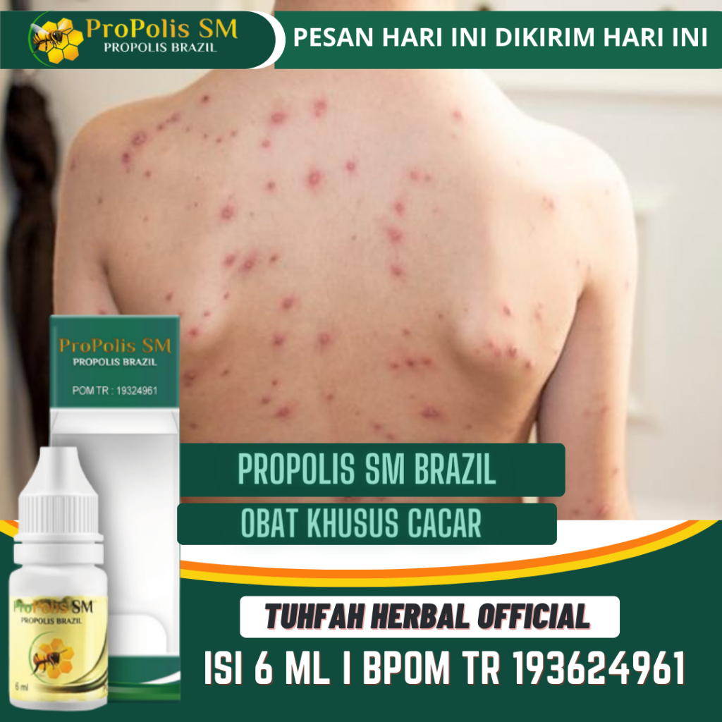 Jual Obat Penghilang Cacar Air untuk Anak dan Dewasa, Cacar Api, Herpes ...