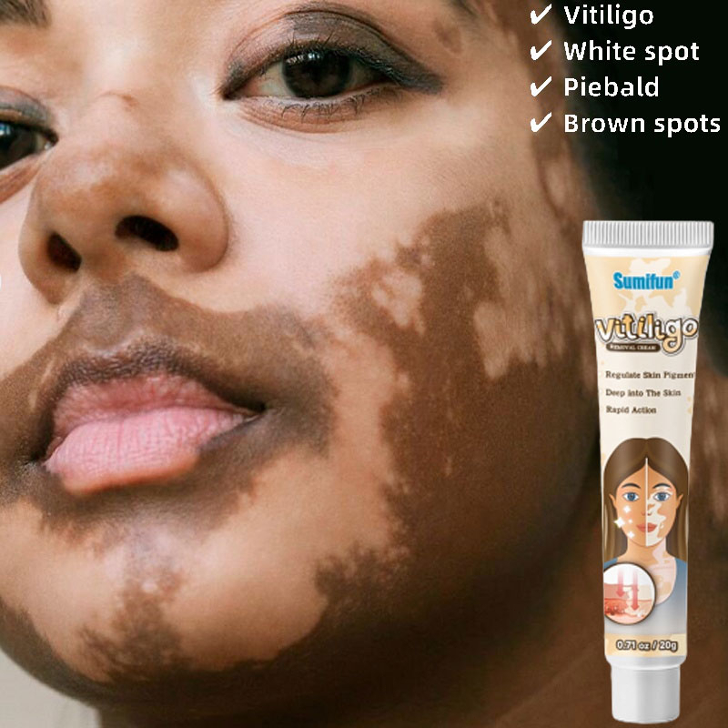 Jual [COD ] Salep vitiligo, panu, biang keringat, salep panu anti ...