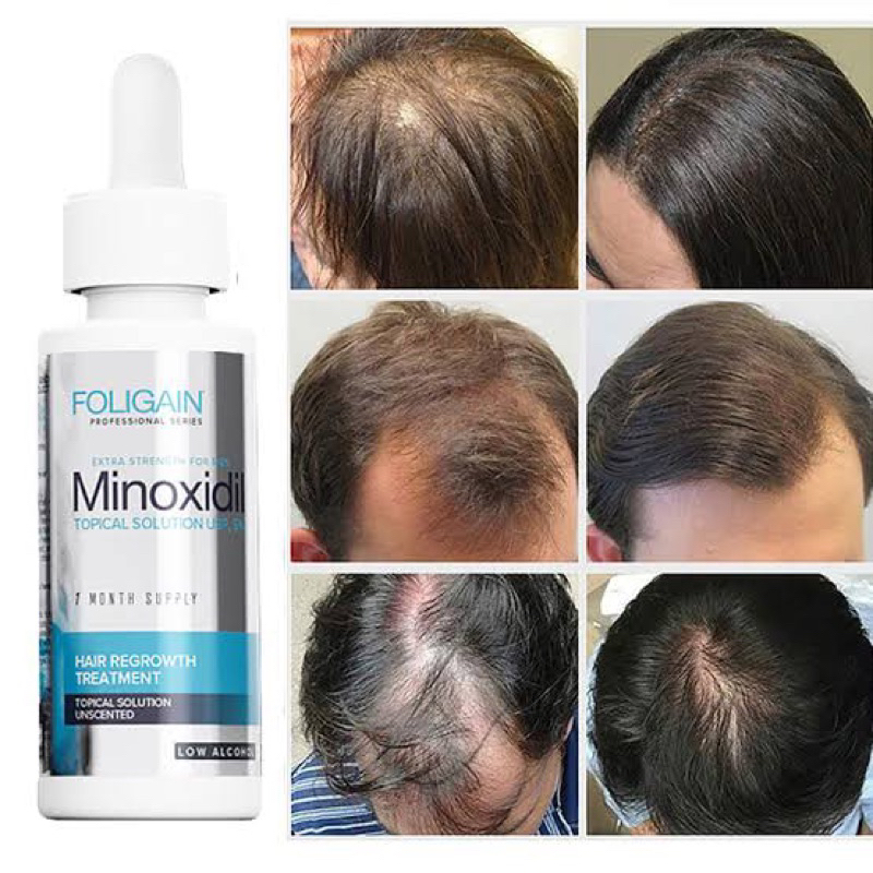 Jual ORI USA - FOLIGAIN MINOXIDIL EXTRA STRENGTH TOPICAL SOLUTION 5% ...