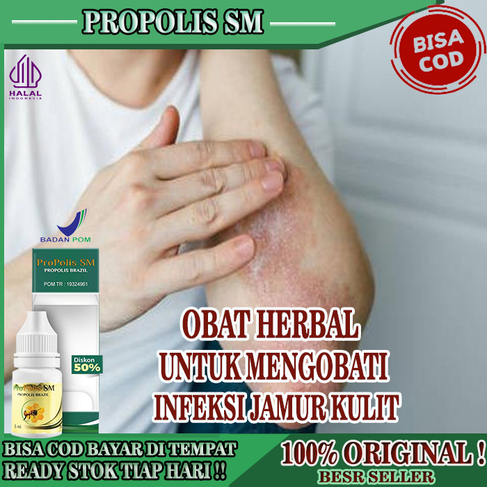 Jual Obat Infeksi Jamur Kulit Tinea Capitis, Obat Gatal Kurap Kepala ...