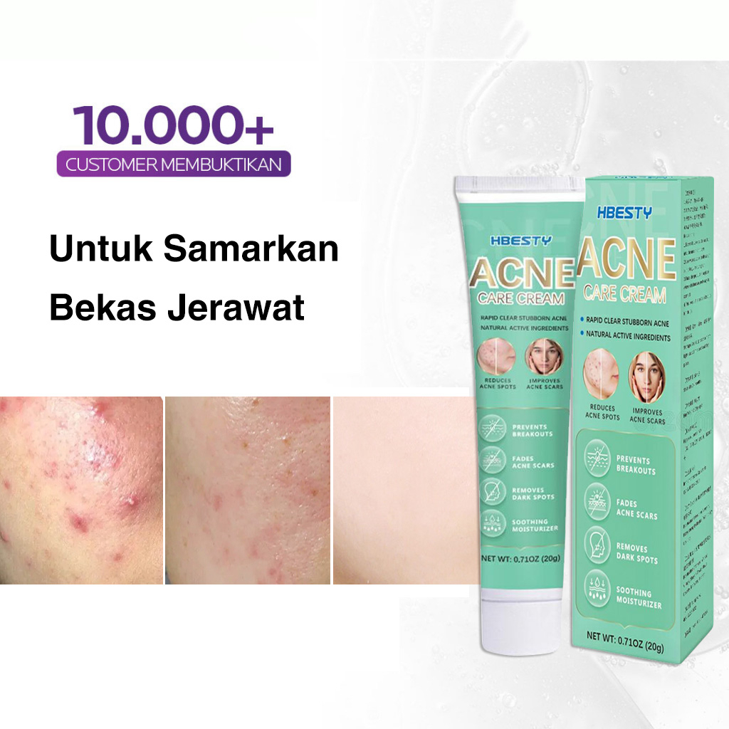 Jual Cream Penghilang Bekas Jerawat | Bopeng,dan Flek | penghilang ...