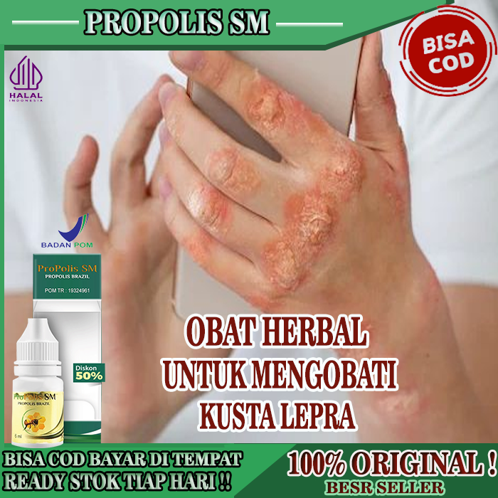 Jual Obat Kapsul Penyakit Kusta Lepra, Obat Untuk Penyakit Kusta Alami ...