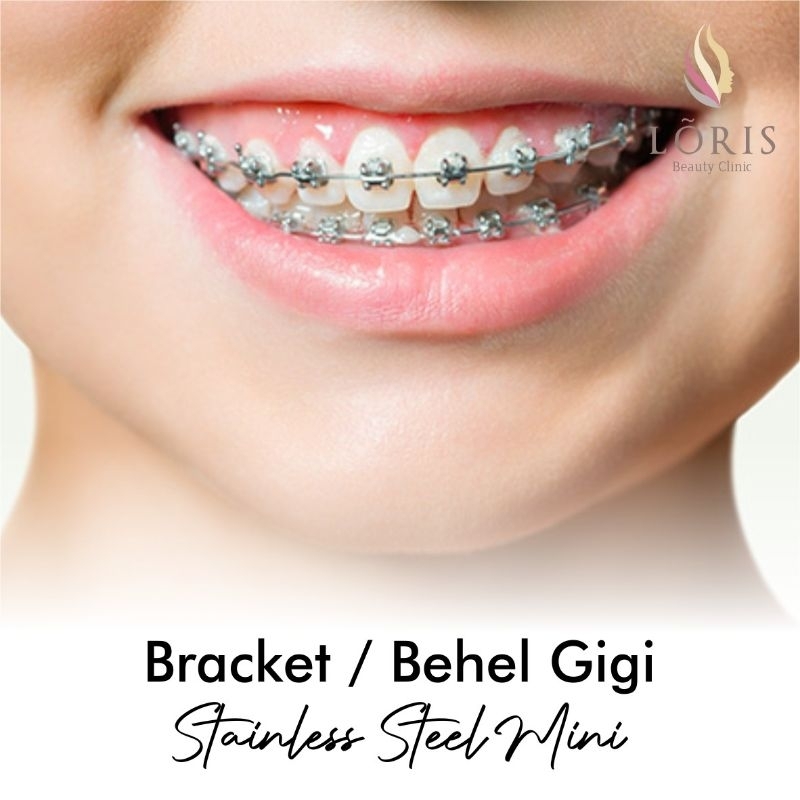 Jual Loris Beauty Bracket/Kawat Gigi/Behel Gigi | Shopee Indonesia