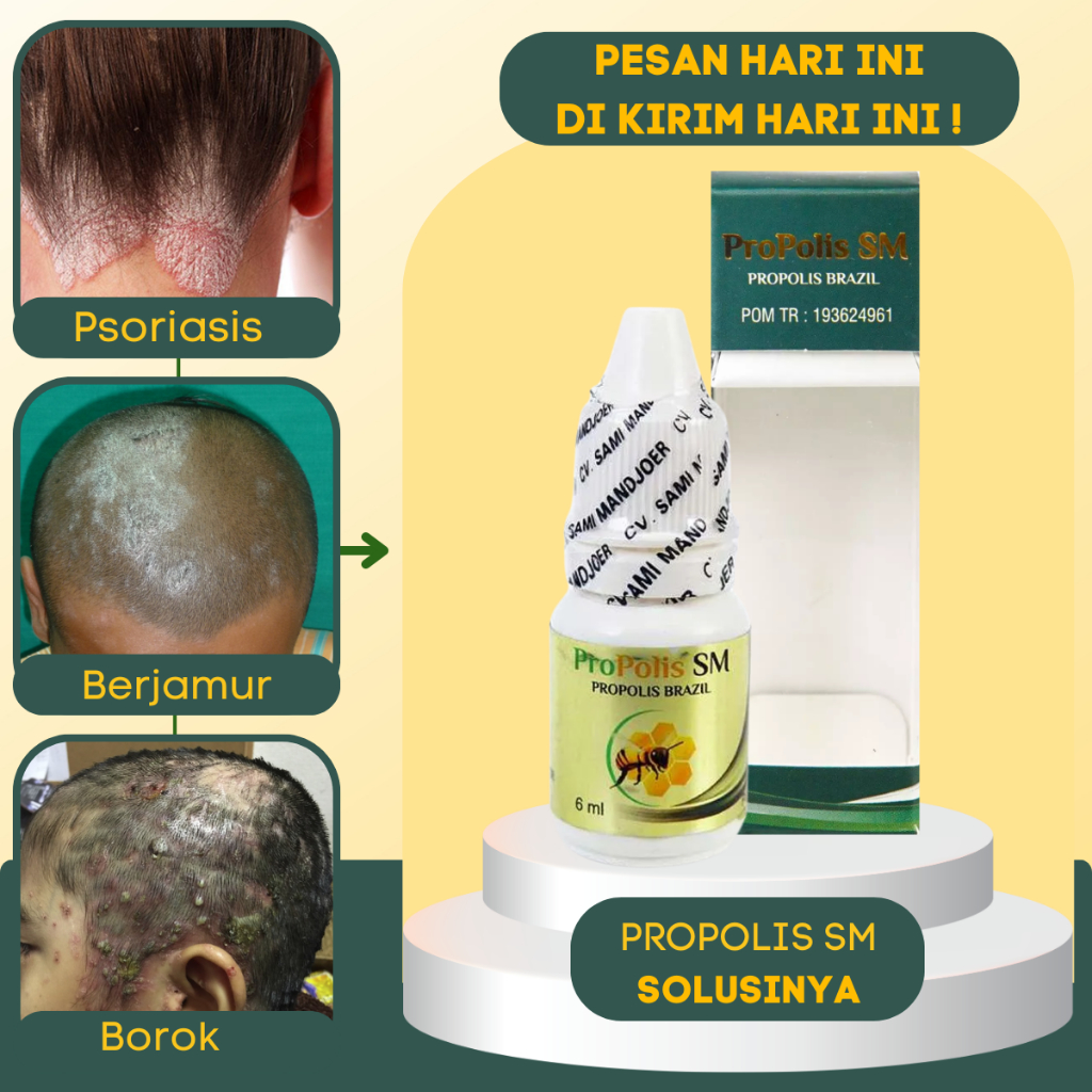 Jual Obat Gatal Kulit Kepala, Obat Psoriasis Kulit Kepala Gatal Berkerak, Kulit Kepala Bersisik ...