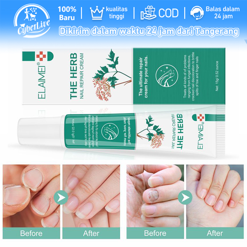 Jual 15g Obat Jamur Kuku Gel Anti Infeksi Obat Kuku Pemutih Kuku ...