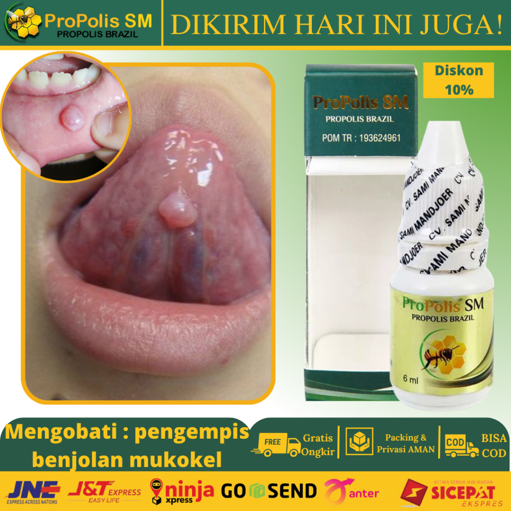 Jual Obat Mukokel penghilang benjolan di bawah lidah, obat benjolan di mulut, obat abses polip ...