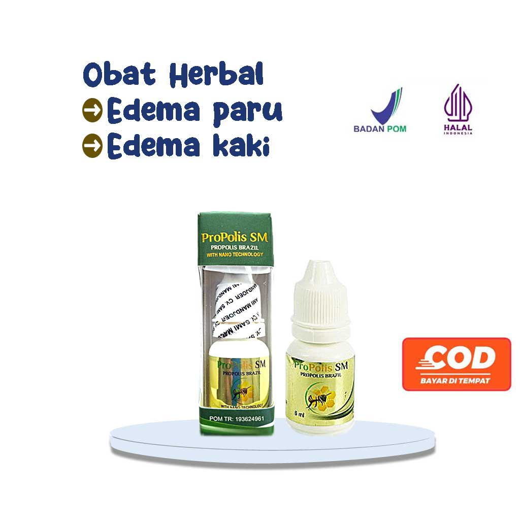 Jual Obat Edema Kaki Bengkak, Edema Paru, Penghilang Penumpukan Cairan ...