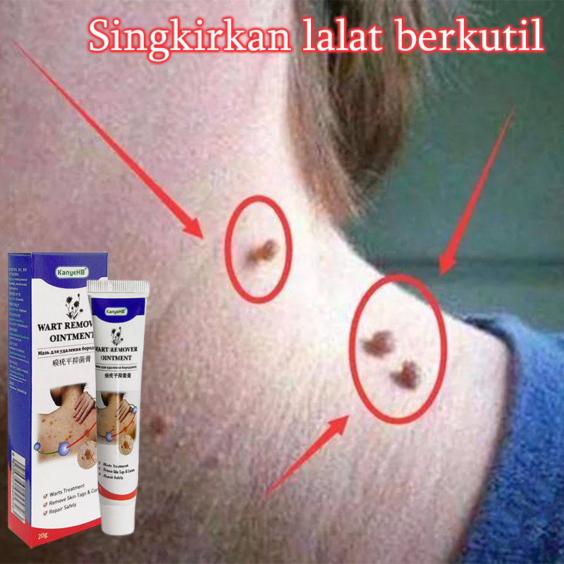 Jual Obat kutil Obat tahi lalat Salep kutil Salep tahi lalat Obat kutil ...