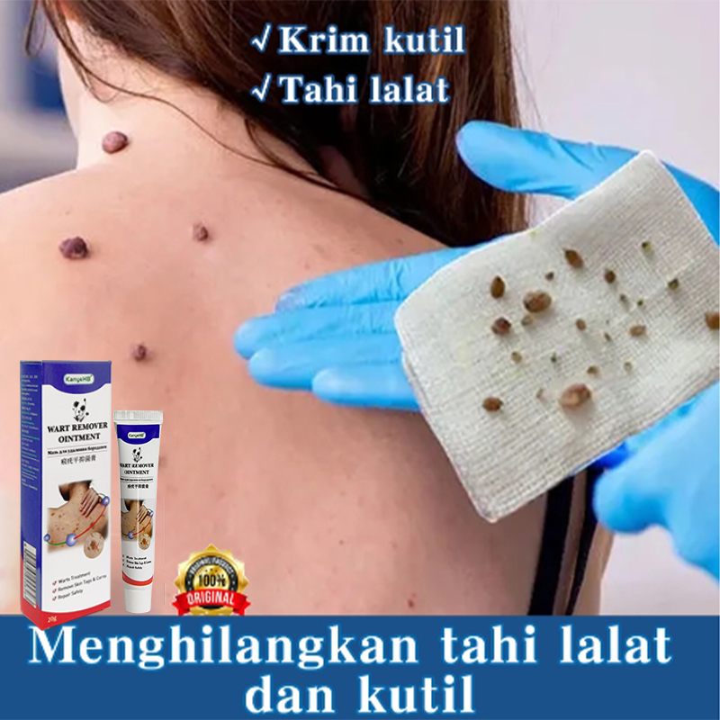 Jual SKIN TAG REMOVER Menghilangkan Kutil Tahi Lalat Mata Ikan ...