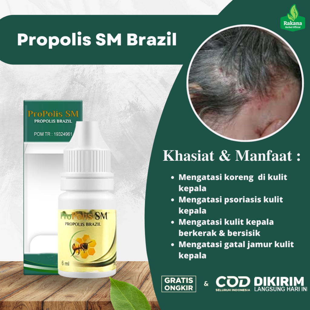 Jual Obat Koreng Di Kulit Kepala, Kulit Kepala Bersisik, Kering Mengelupas - Propolis SM ...