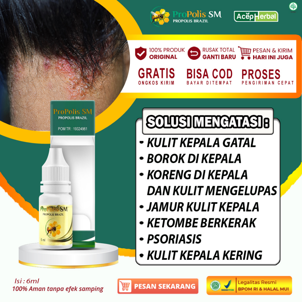 Jual Obat Kulit Kepala Gatal Dan Mengelupas Luka Borok Koreng Di Kulit Kepala Ketombe Berkerak ...