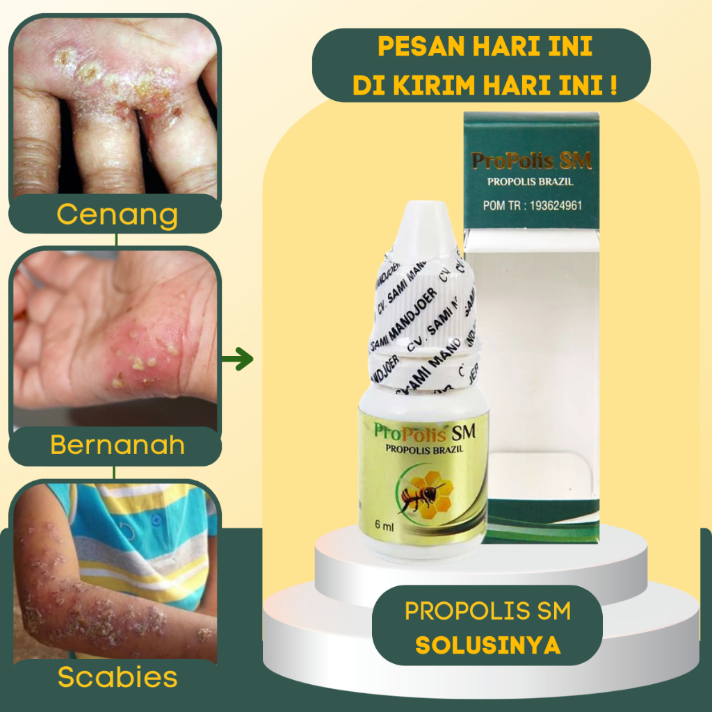 Jual Obat Scabies Manusia, Obat Scabies Manusia Obat Herpes Kulit ...