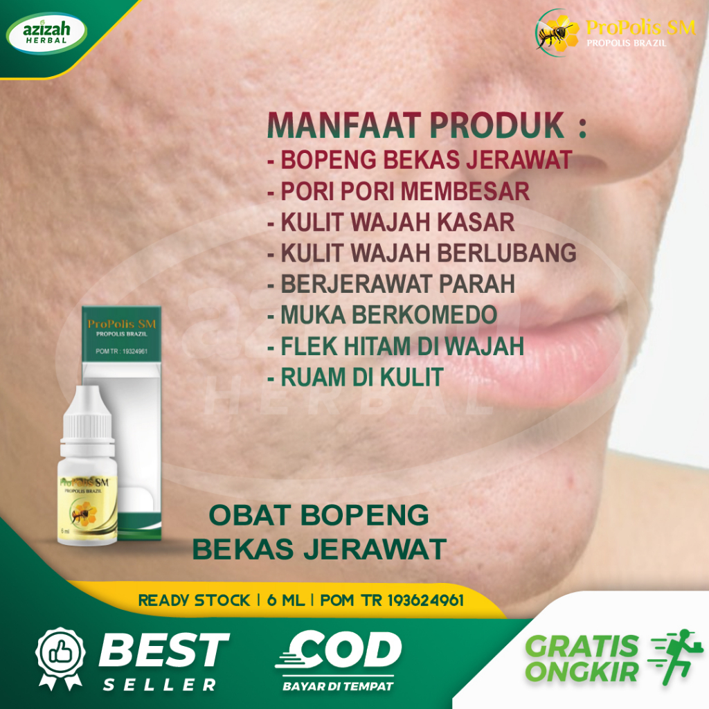 Jual Obat Bopeng Bekas Jerawat Belubang Pori Pori Membesar Flek Hitam ...