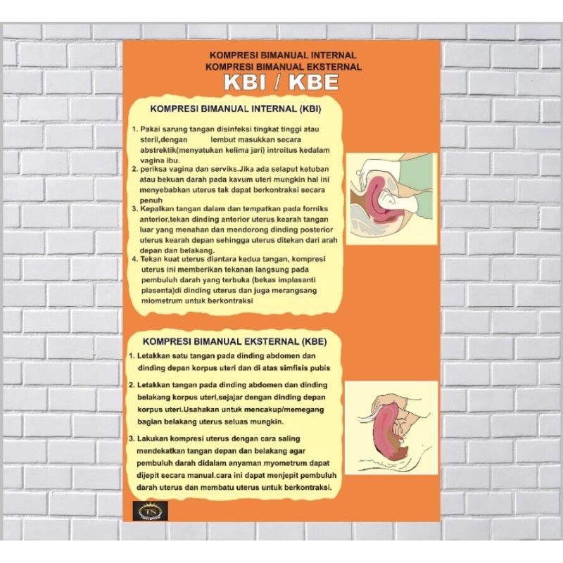Jual Poster Kesehatan Tentang KBI/KBE = Kompresi Bimanual Internal, Kompresi Bimanual Eksternal ...