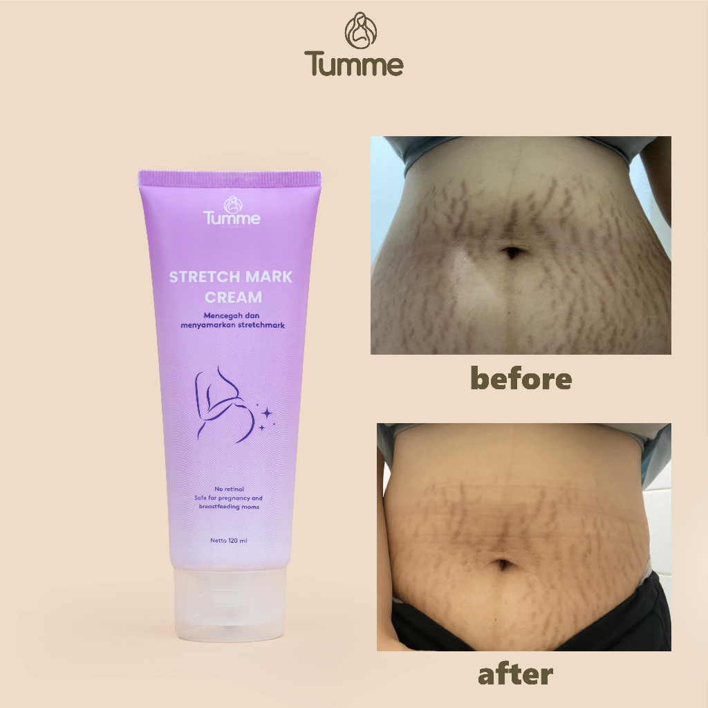 Jual BUY 1 GET 1 TUMME STRETCH MARK CREAM UNTUK IBU HAMIL | Shopee ...