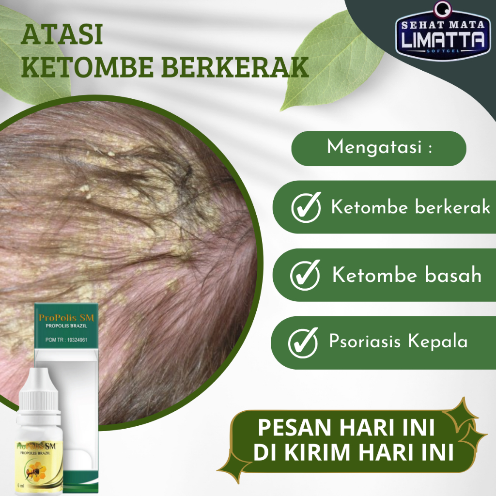 Jual Propolis SM - Obat Ketombe Berkerak Parah, Penghilang Ketombe Bersisik, Obat Borok Korengan ...