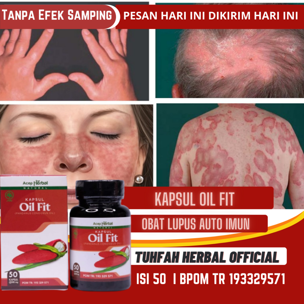 Jual Obat Lupus Ruam Wajah Autoimun, Penyakit Kusta, Radang Kulit, Ruam ...
