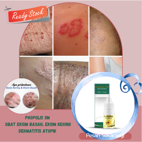 Jual PROPOLIS SM - Obat eksim basah, eksim kering dermatitis atopik ...