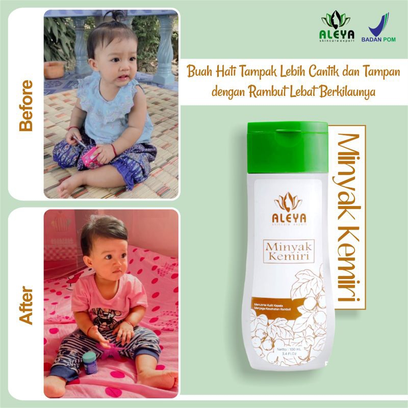 Jual Minyak Kemiri Ibu Dan Anak Fora Penyubur Rambut Bayi Penumbuh ...