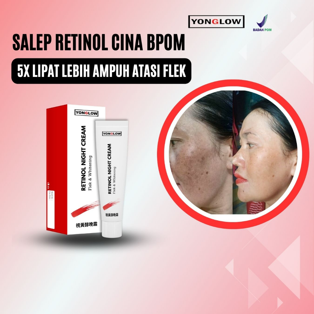 Jual Salep Cina Flek BPOM Yonglow Skincare Salep Malam Flek Noda Hitam ...