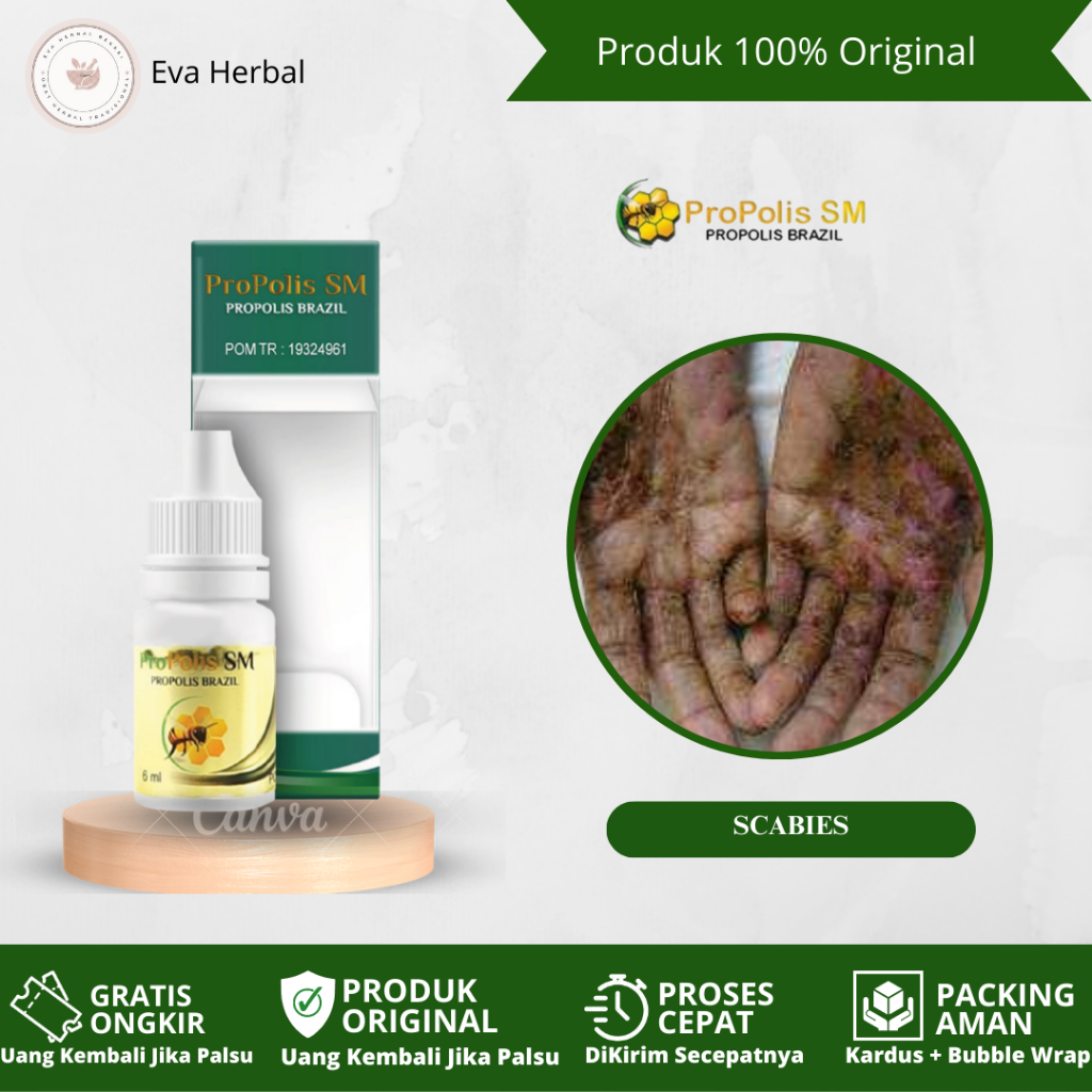Jual Obat Scabies, Kulit Gatal-Gatal, Penyakit Scabies (Kudis ...