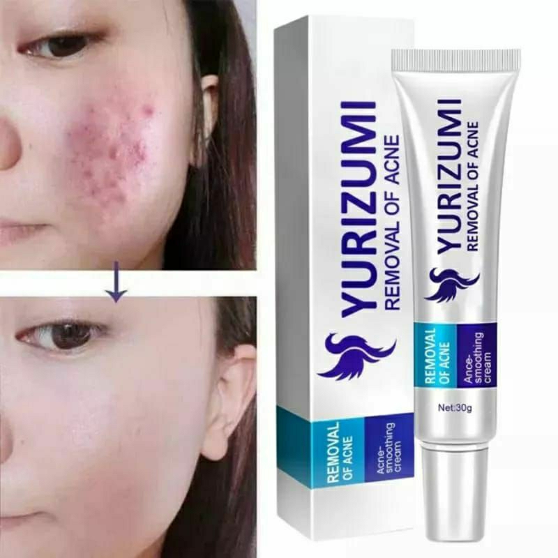 Jual Obat Jerawat Paling Ampuh Menghilangkan jerawat dan bekasnya dalam ...