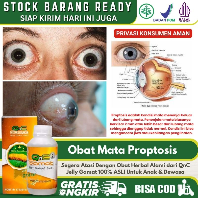 Jual Obat Untuk Mata Menonjol Sebelah Akibat Hipertiroid, Obat Penyakit ...