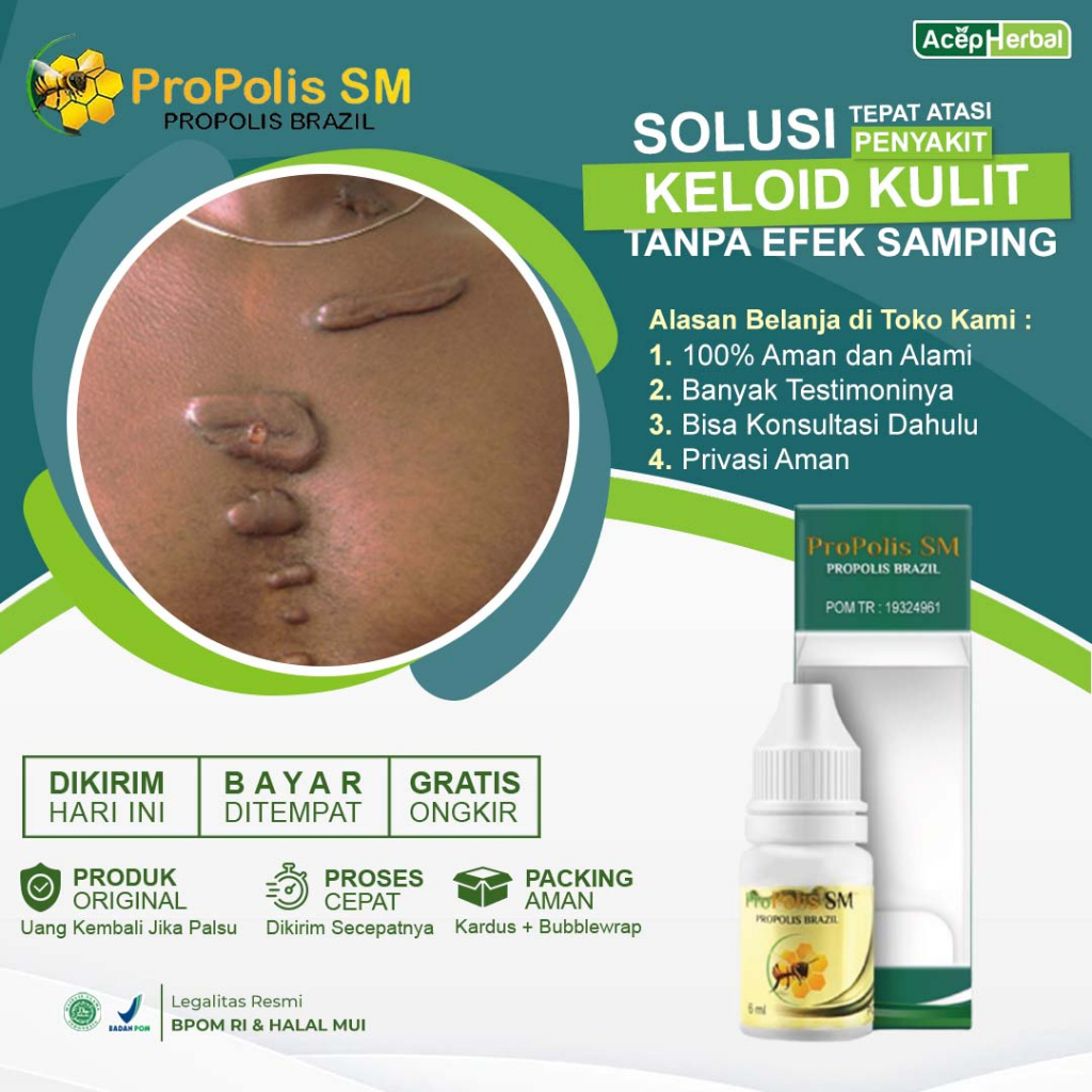 Jual Propolis SM - Obat Keloid, Obat keloid Luka Tindik, Obat Kutil ...