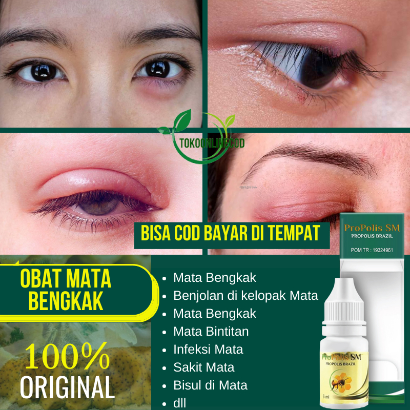Jual Obat Kelopak Mata Bengkak , Kelopak Mata Turun Sebelah , Sakit ...